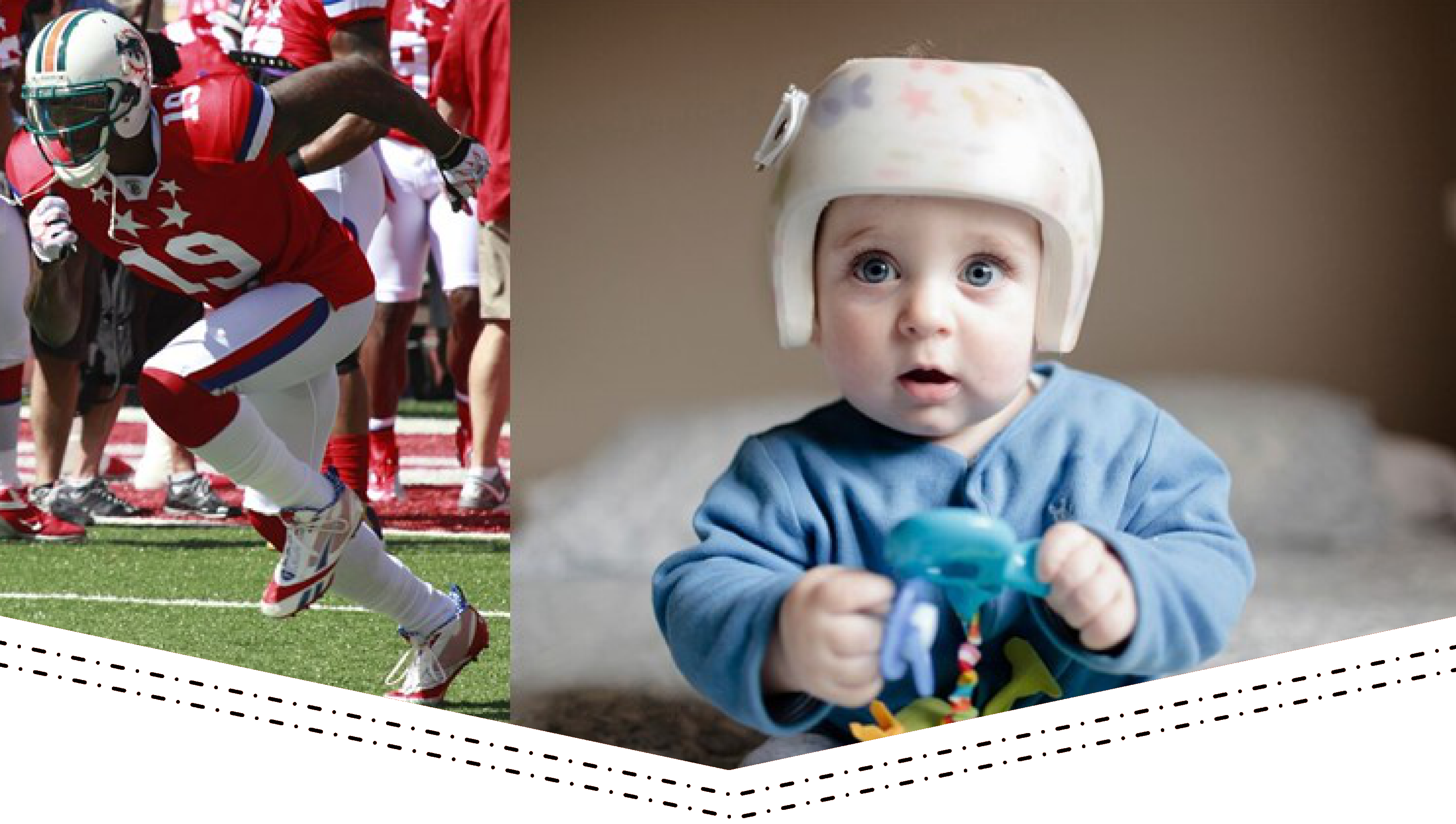 Cranial Remolding Helmets - Presque Isle Medical Technologies ...